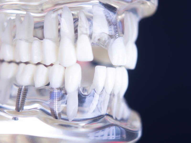 Multiple Dental Implants - Kluth-Richardson Family & Cosmetic Dentistry